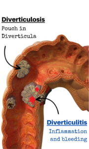Diverticulitis Diet PDF [Free Download] - The Geriatric Dietitian